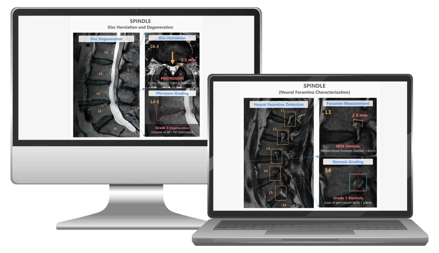 Spindle by Synapsica | AI Assistant for MRI Spine Reporting
