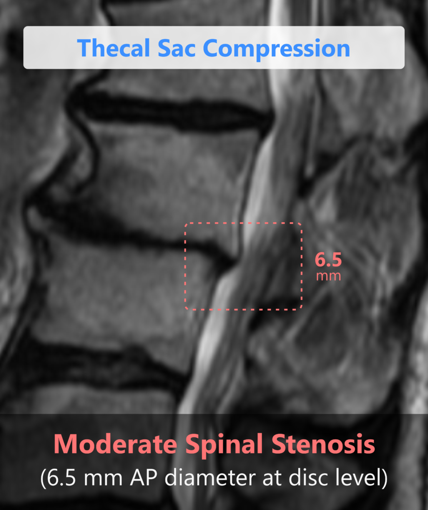 Spindle by Synapsica | AI Assistant for MRI Spine Reporting