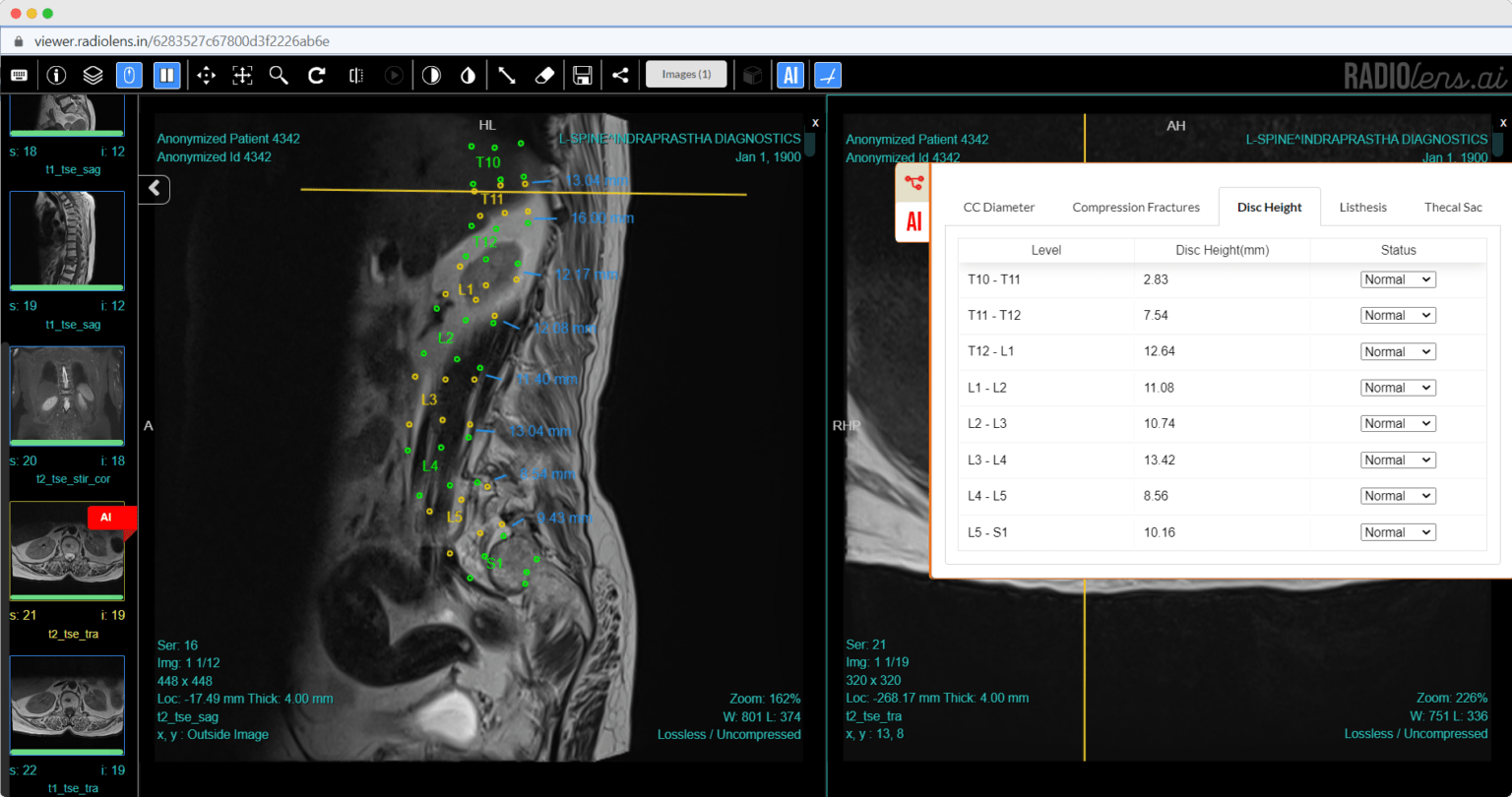 Future of Spine Reading | AI Radiology Software | Spindle